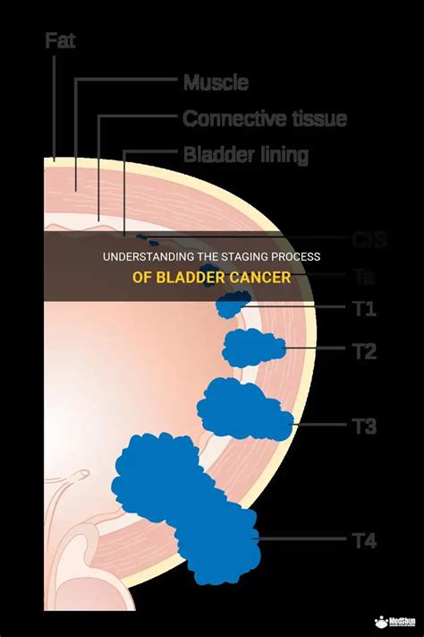 Understanding The Staging Process Of Bladder Cancer Medshun