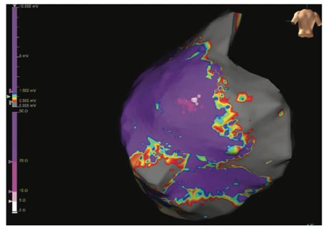 Pacemaker Exit Block An Unusual Cause Of Ventricular Tachycardia