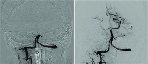 Angiography Before The Second Thrombectomy Basilar Artery Occlusion Download Scientific