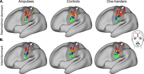 Complex Pattern Of Facial Remapping In Somatosensory Cortex Following Congenital But Not