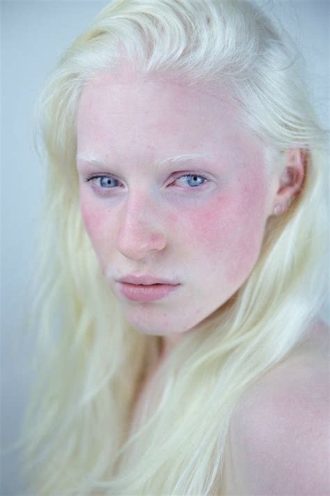 Albino People With Purple Eyes Albino Girl Purple Eyes