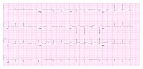 Postoperative ECG Revealing Diffuse Concave Upwards ST Segment Download Scientific Diagram