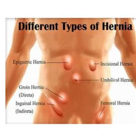 Inguinal Hernias Treatment At ₹ 2500 Person In Noida Id 25990632755