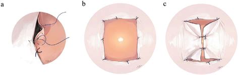 Suturing Techniques A Suturing An In Lay Fascial Graft And The Dura