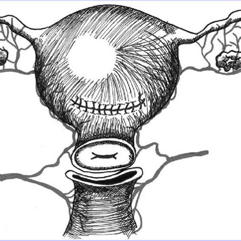 The Circumferential Tearing Of The Vaginal Vault Separating The Cervix Download Scientific