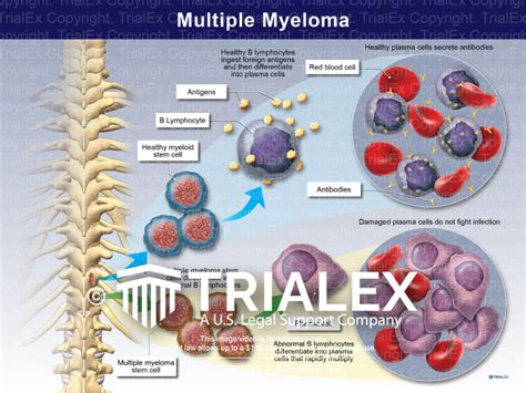 Multiple Myeloma TrialQuest Inc