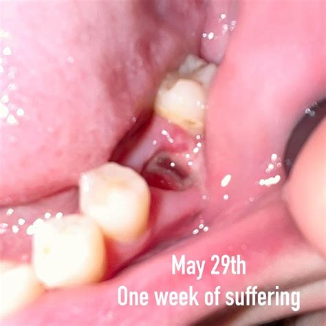 Molar Tooth Extraction Site Dry Socket Healing Day 1 9 Pic Of All 3