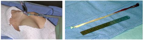 Ulnar Collateral Ligament Reconstruction Arthrex Ucl