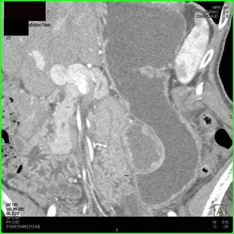 Gastric Gist Tumor Stomach Case Studies Ctisus Ct Scanning Gastric Gist Tumor Stomach Case Studies Ctisus Ct Scanning