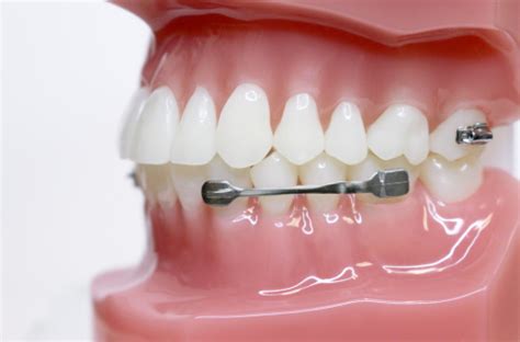 Motion 3d Class Iii Appliance Henry Schein Orthodontics