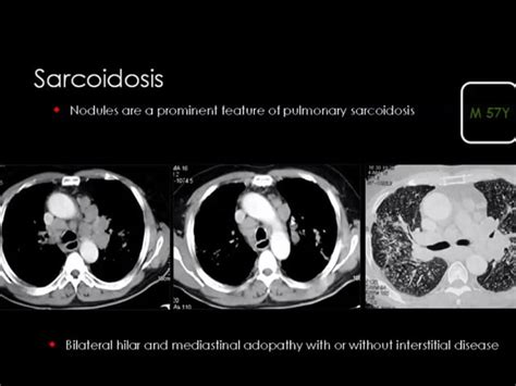 Hrct Nodular Pattern Ppt