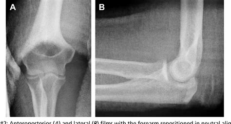 Simple Elbow Dislocation Semantic Scholar