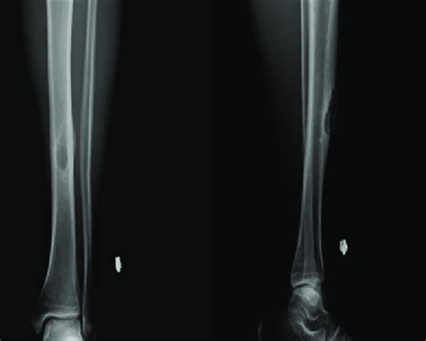 Anteroposterior And Lateral Radiographs Of The Left Tibia And Fibula Download Scientific Anteroposterior And Lateral Radiographs Of The Left Tibia And Fibula Download Scientific