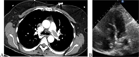 A Computed Tomography Scan Of The Central Pulmonary Embolism B