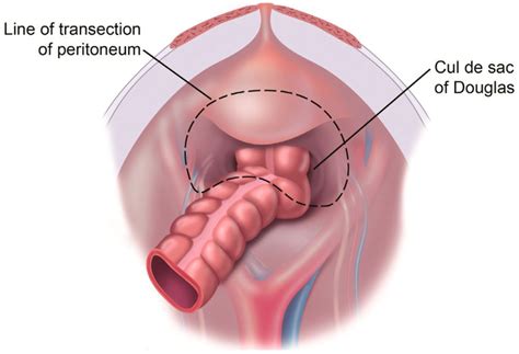 Pelvic Peritonectomy From Sugarbaker Et Al 7 With Permission