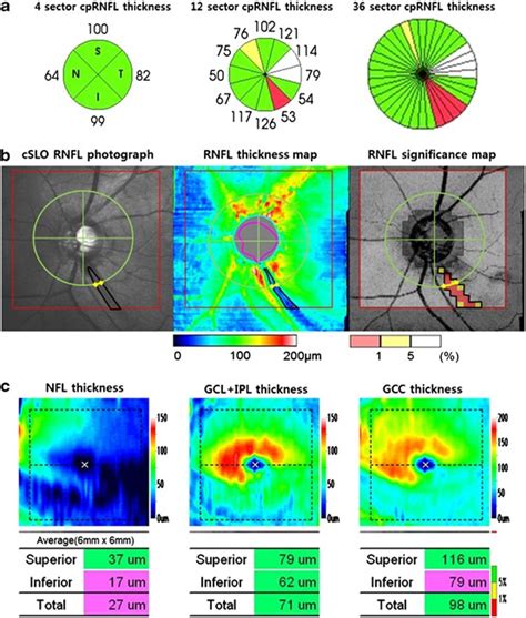 Diagnostic Ability Of Retinal Nerve Fiber Layer Maps To Detect Localized Retinal Nerve Fiber