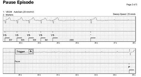 Remote Cardiac Monitoring Implantable Device Pacemaker