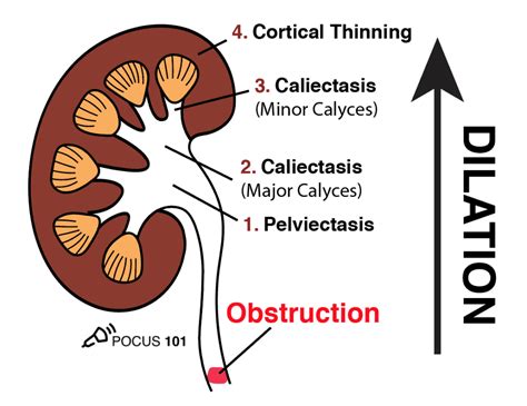 Hydronephrosis Grading Ultrasound