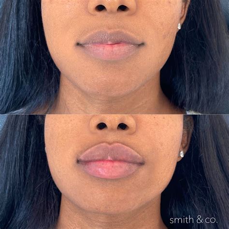 Lip Injections Natural At Anna Beyers Blog