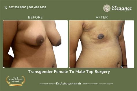 Transgender Surgery Male To Female Operation