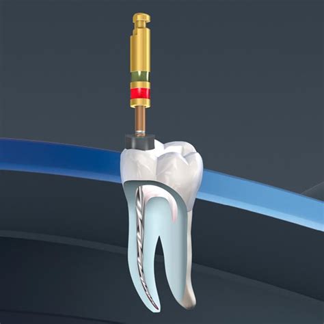 Komet France Materiel Endodontie