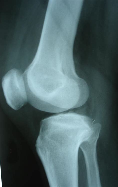 Knee Dislocation Trauma Orthobullets