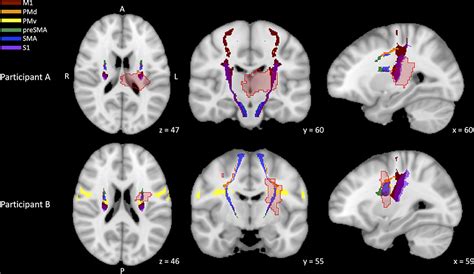 Frontiers Clinical Imaging Derived Metrics Of Corticospinal Tract