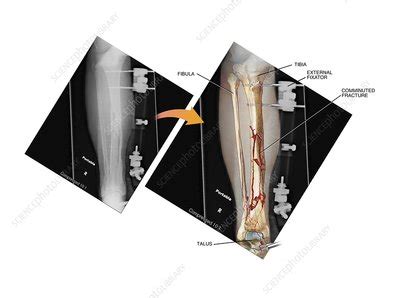 External Fixation Of Fractured Tibia Stock Image C021 0806 Science Photo Library