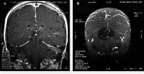 Patients Mri And Mrv Showing A Coronal T1 Post Contrast Venogram Of