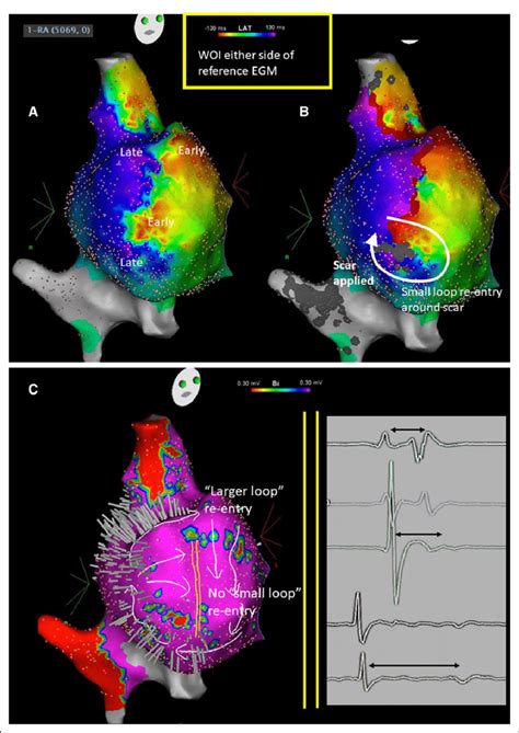 Randomized To Local Activation Time Lat Mapping Interpolation