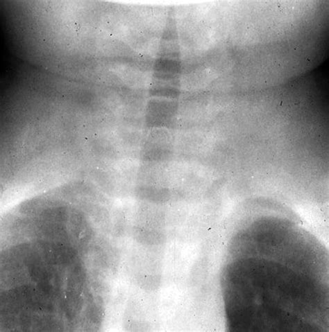 Stridor Clinical Tree