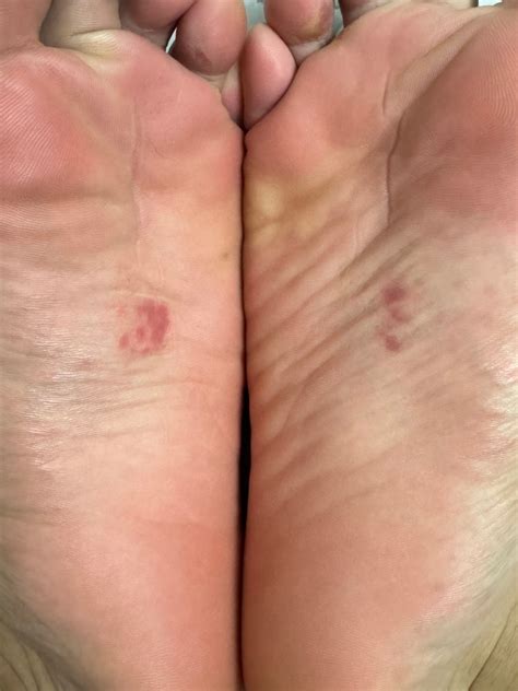 혹시 이거 무좀 증상인가요 지식in