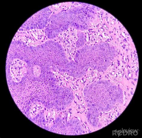 Buccal Mucosa Squamous Hyperplasia Show Hyperplastic Squamous Posters For The Wall • Posters