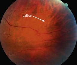 Lattice Degeneration Clinical Gateclinical Gate