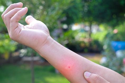 What Do Insect Bites Look Like Day Lewis