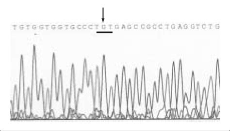 Electropherogram Showing The Sequence Tgt At Codon 220 In Exon 6 Of The
