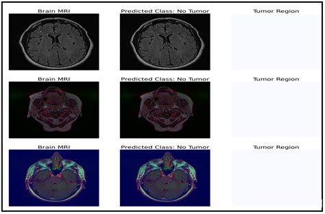 Brain Tumor Detection And Classification Using Fine Tuned Cnn With Resnet50 And U Net Model A