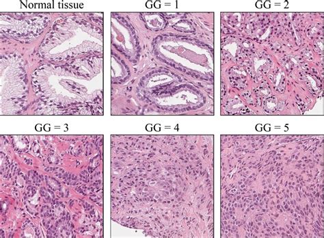 Figure 1 From Impact Of Stain Normalization On Pathologist Assessment