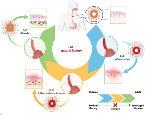 Full Article Eosinophilic Esophagitis In The Era Of Biologics
