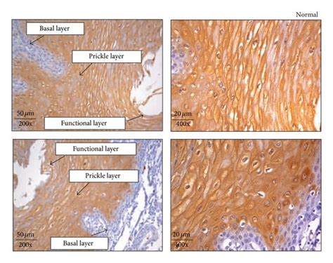 Expression Of S100 Calcium Binding Protein A9 In Normal Esophageal