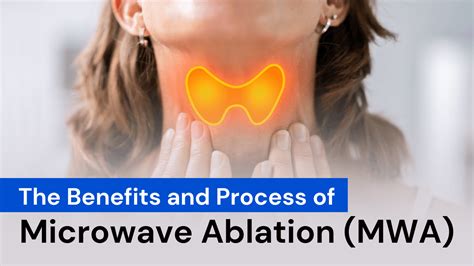 Save Your Thyroid Exploring Microwave Ablation For Thyroid Nodules Thyroid Savers