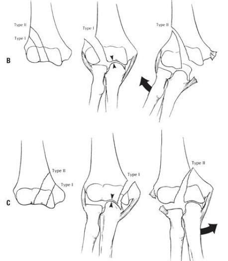 Condylar Fractures Classification Rayorthos