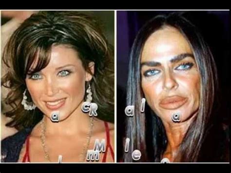 Plastic Surgery Before And After Gone Wrong Youtube