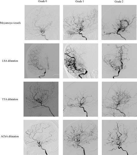 Frontiers Angiographic Features And Progression Risk Factors In