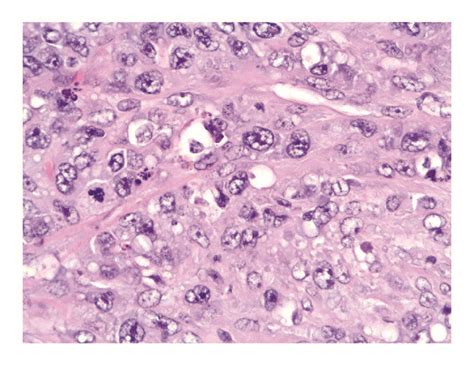 Large Cells With Pleomorphic Nuclei Some With Folded Nuclear Contours Download Scientific