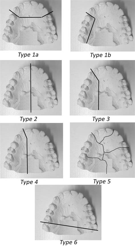 Maxillary Fracture Classification