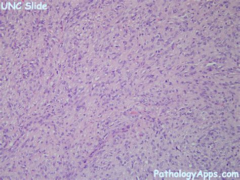 Gist Pathology