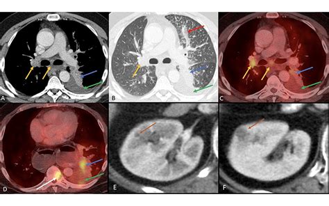 Radiologists And Cancer Radiogenomics Rsna