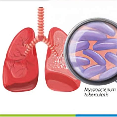 Tuberculosis Tb Predictiontop 75 Countries Kaggle