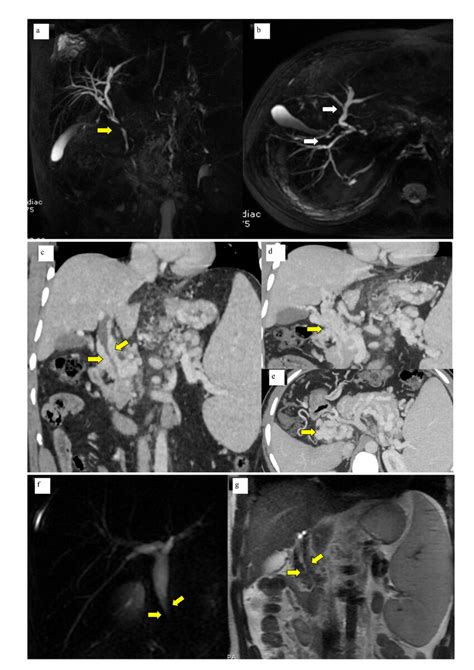 A Mrcp Coronal And B 3d Axial Mrcp Showing Extrahepatic Bold Yellow